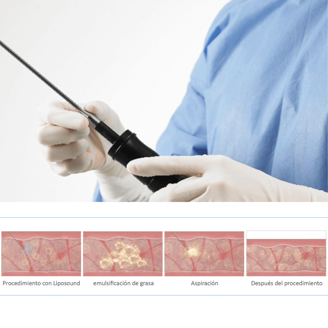 Liposound - Lipólisis ultrasónica VASER - IMVMED